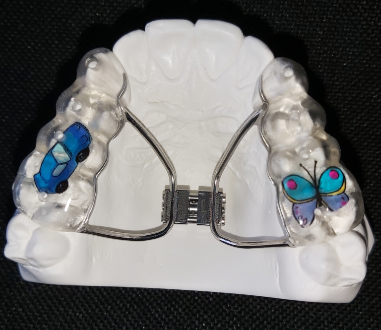 Expansion forcée - Laboratoire Dentaire ORTHODESIGN Sarl